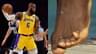 LeBron James Toes: Does the King Need Toe Surgery? Have His Signature ...